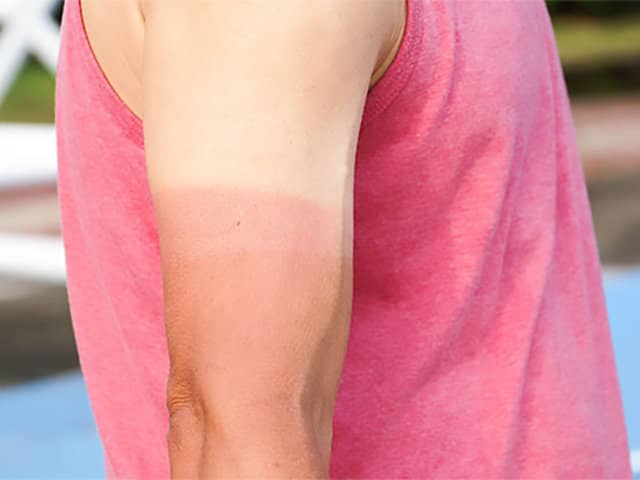 How to Sleep with a Sunburn | Sleep Number